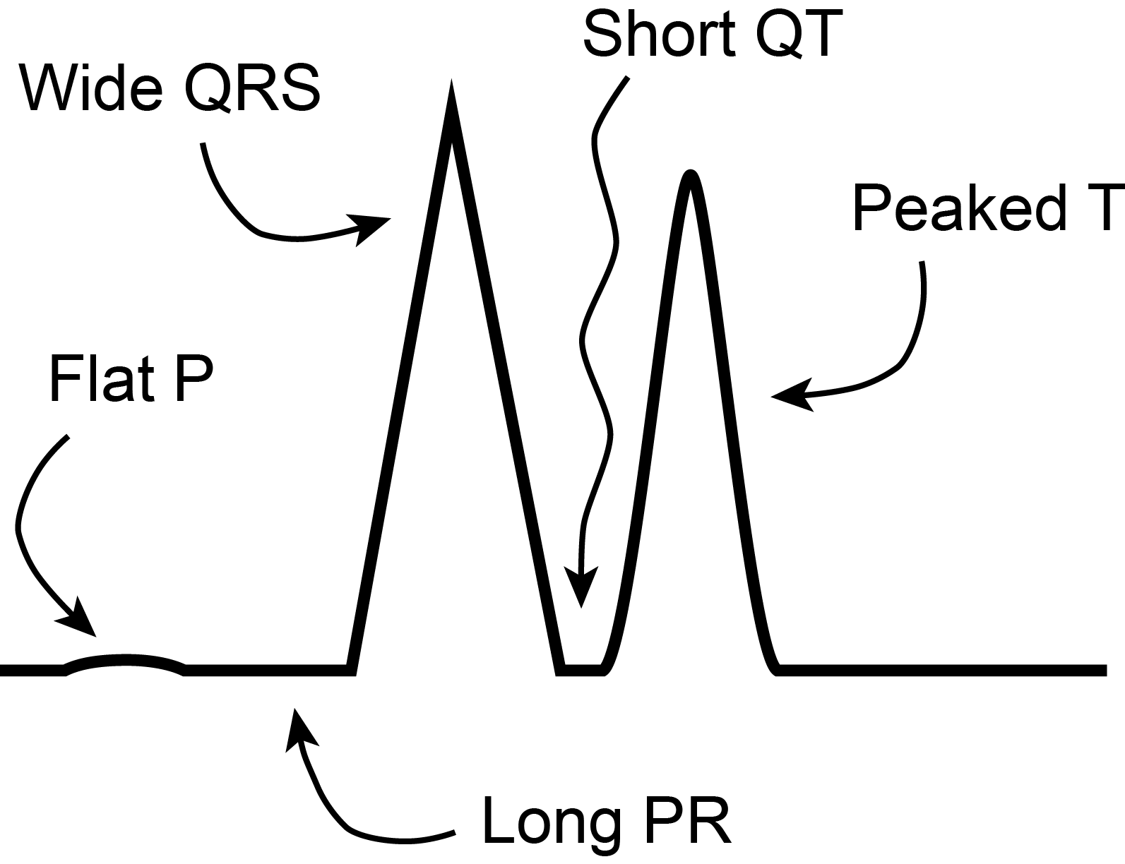Potassium and Arrhythmias - Clinician Revision
